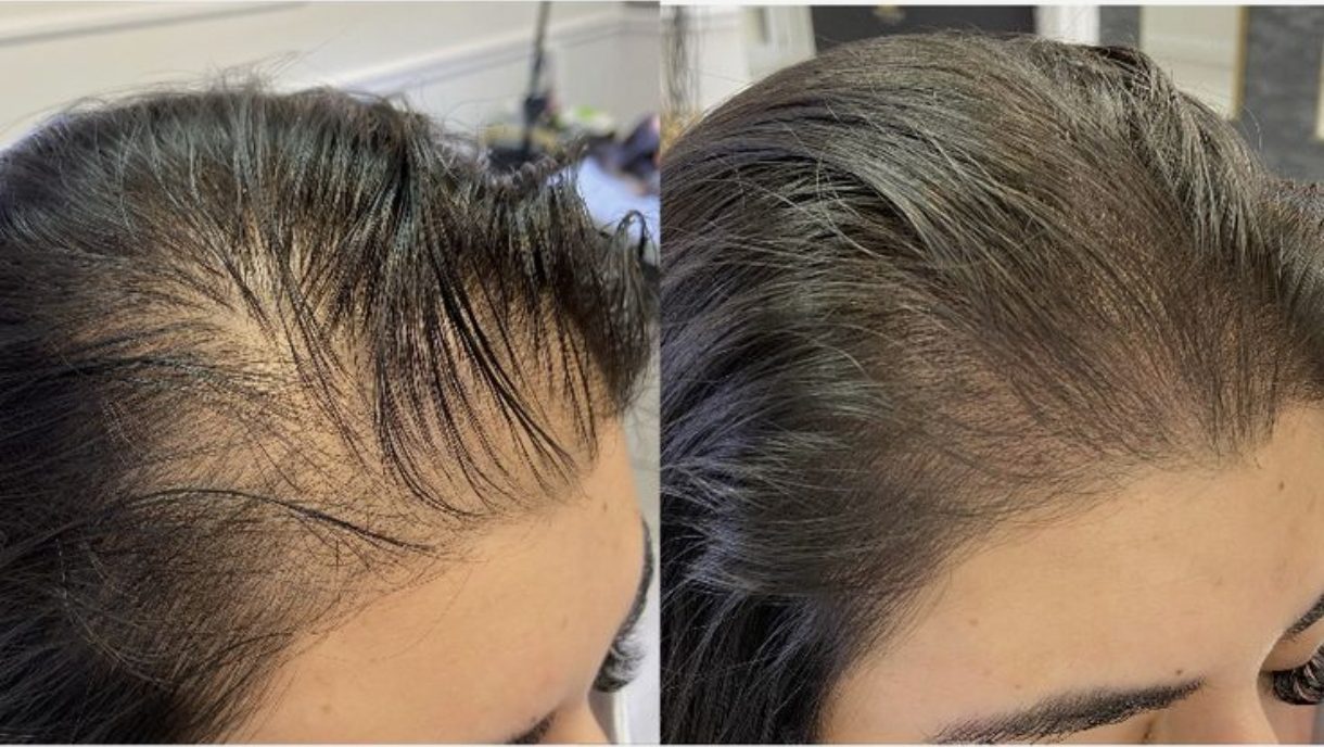Micropigmentación para Mujer - Soluciones para la Pérdida de Cabello ...